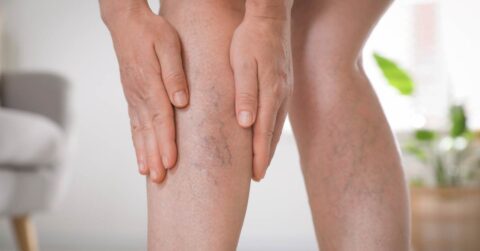 5 signos tempranos de las varices y cómo actuar a tiempo | VARIcentro ...